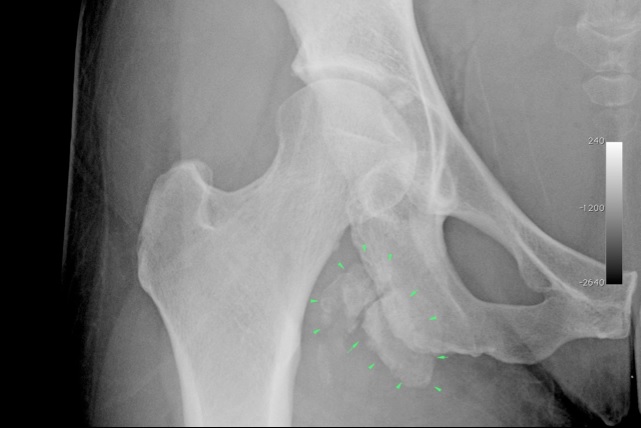 Hamstring Tendon Tears FAQs | Hip and Pelvis | Doctor Articles | Asia Medical Specialists